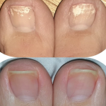 I tested Lunavia Toenail Fungus Pen: here's my 2-Weeks Reviews - Snoopviews